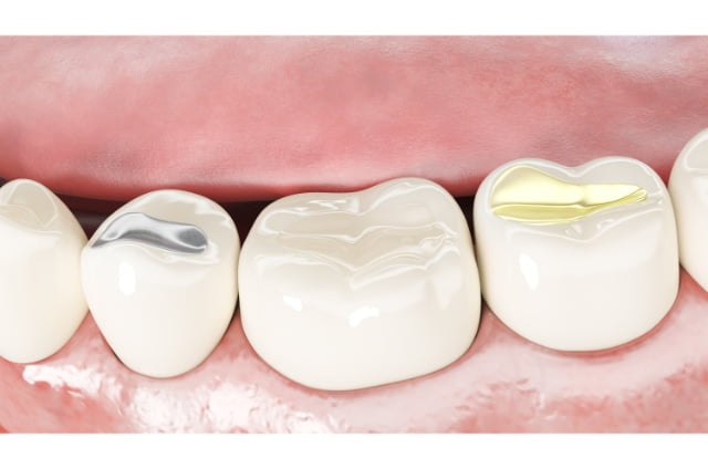 Understanding Dental Fillings and Their Importance