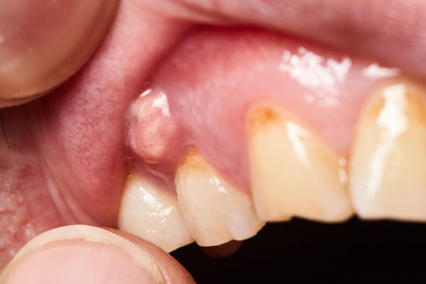 Tooth Abscess Stages and How to Repair a Dental Abscess